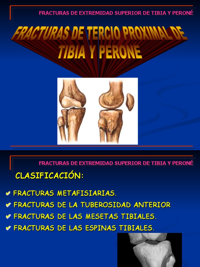 FRACTURA DE Tibia Proximal | PDF | Rodilla | Sistema esquelético
