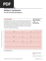 Wellens Syndrome ECG Patterns Explained | PDF | Electrocardiography ...
