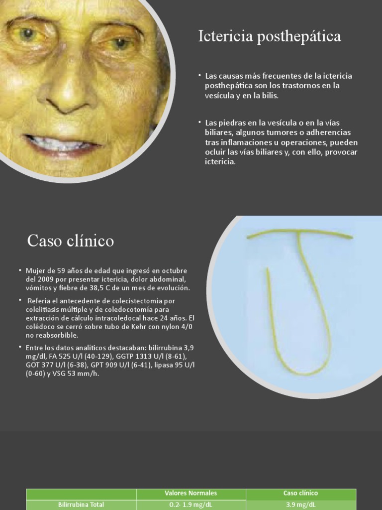 Causas de Ictericia Posthepática en Mujer | PDF