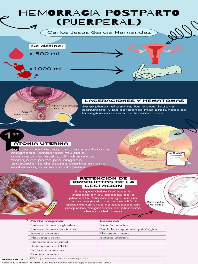 Hemorragia Postparto Carlos García | PDF