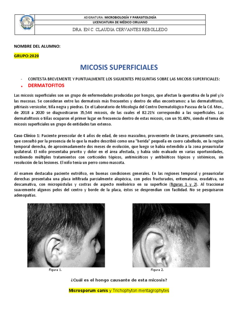 Casos Clinicos-Micosis Superficiales | PDF
