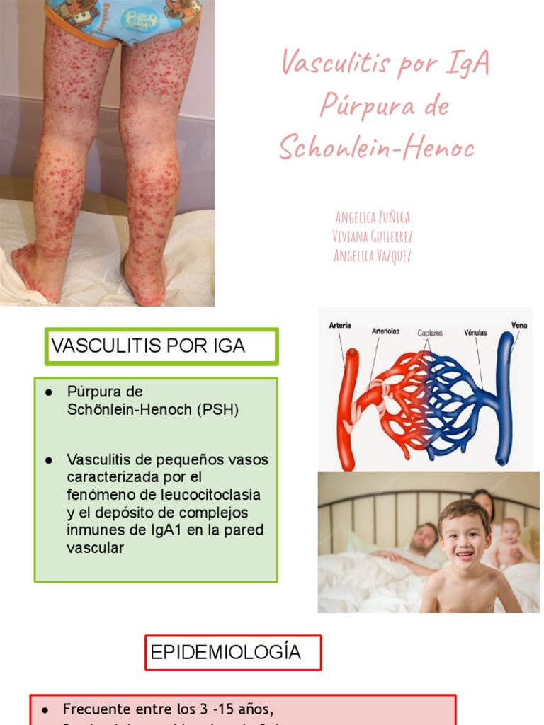 Vasculitis Por IgA Purpura de Schonlein-Henoch | PDF | Especialidades ...