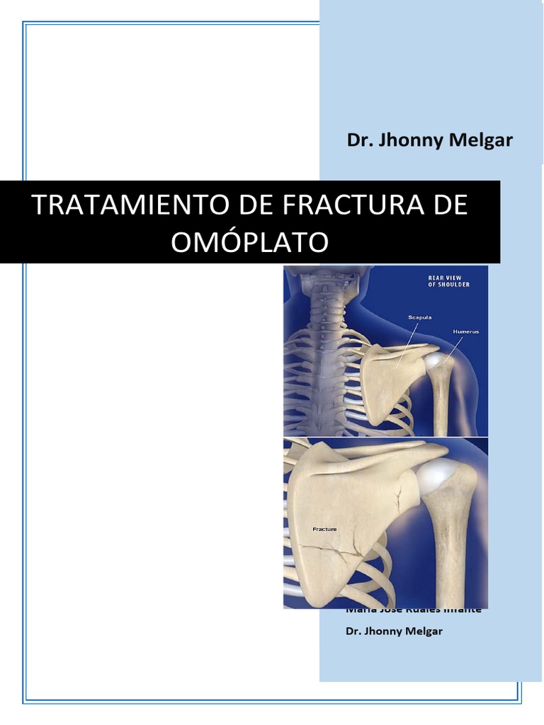 Tratamiento de Fractura de Omóplato-Ruales | PDF | Extremidades ...