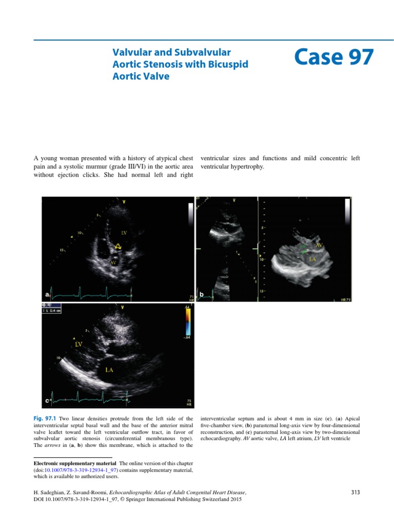 Valvular and Subvalvular Aortic Stenosis With Bicuspid Aortic Valve ...