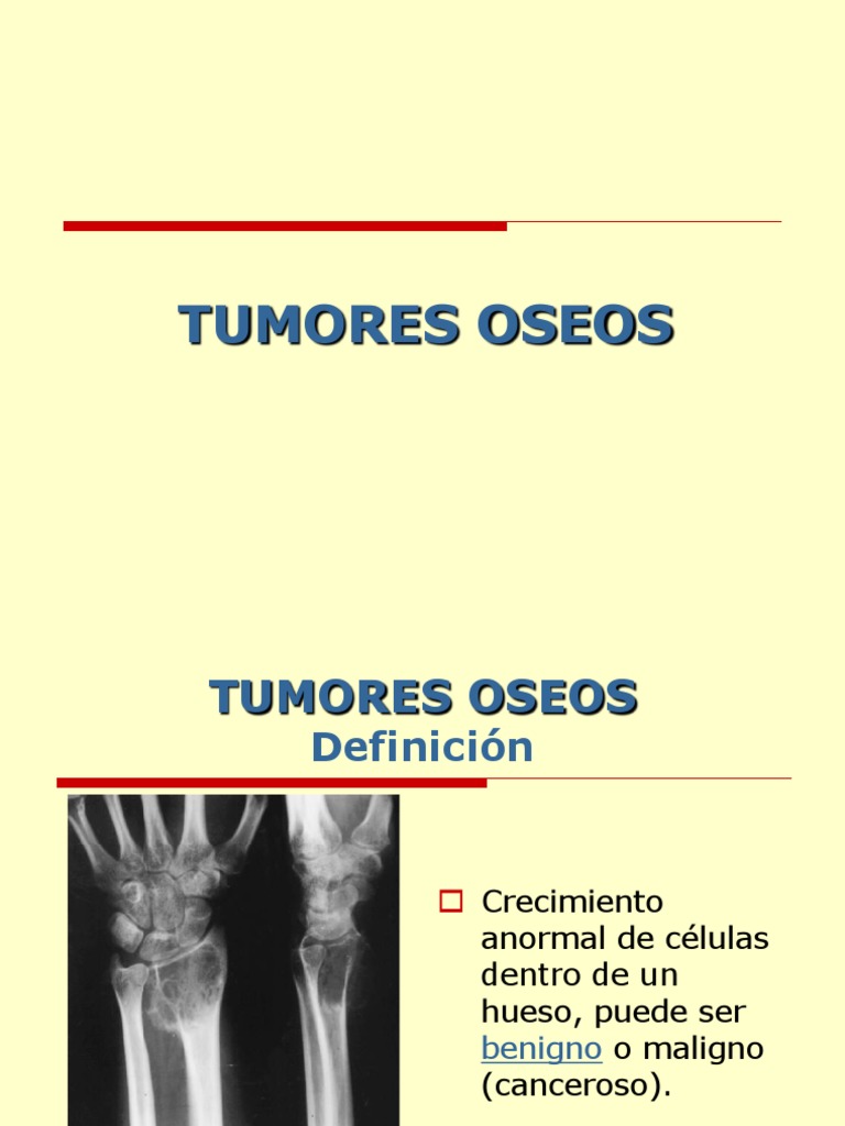 TUMORES_OSEOS | PDF | Cáncer | Sarcoma