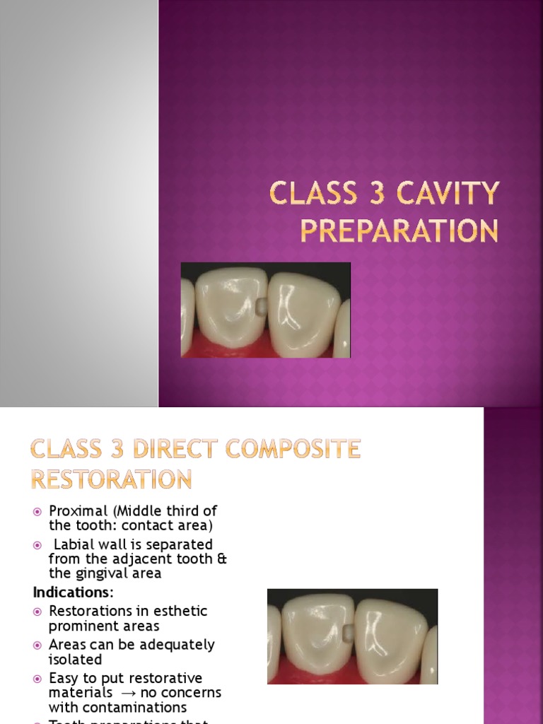 Class 3,4 and 5 | PDF | Tooth Enamel | Dentistry Branches