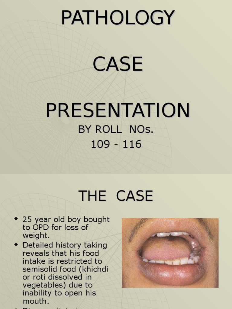 oral submucous fibrosis | Biopsy | Tongue