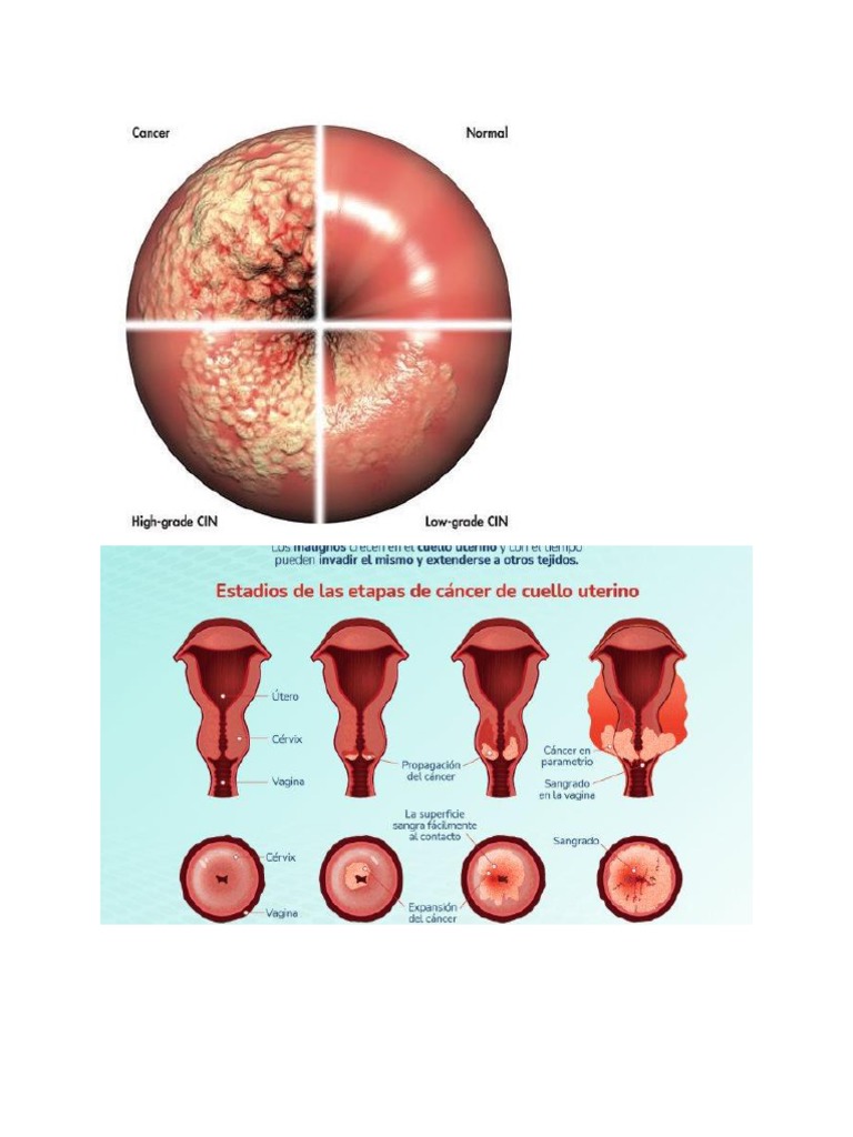 Cancer Cervicouterino | PDF