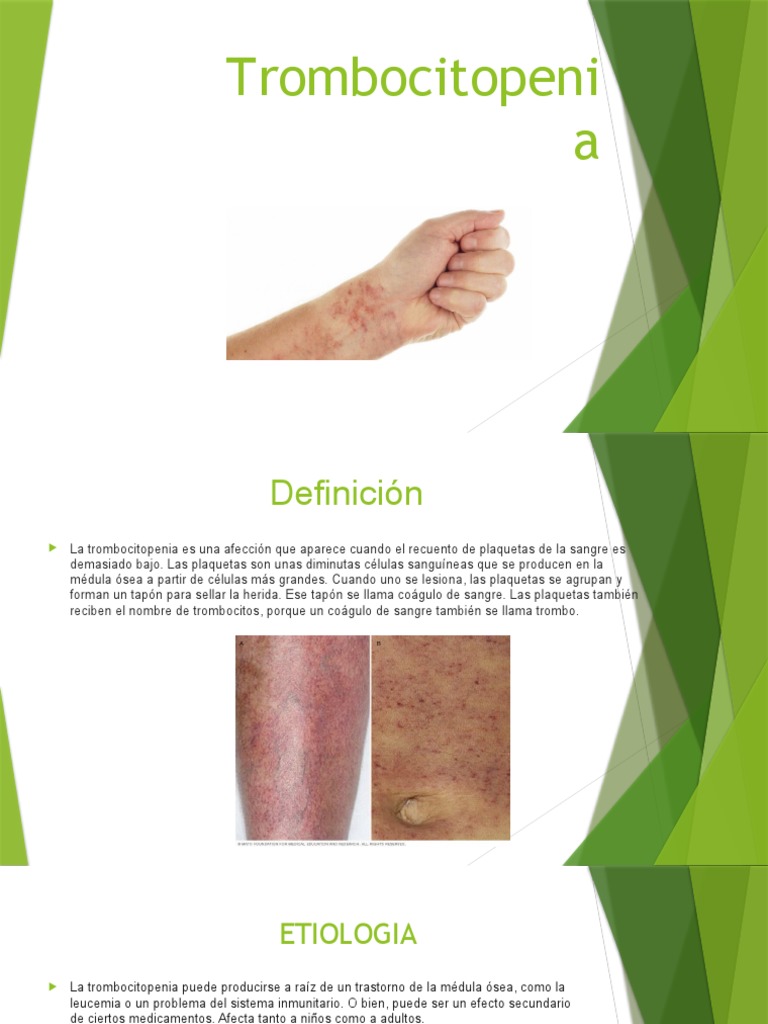 Trombocitopenia | PDF | Sangre | Plaqueta