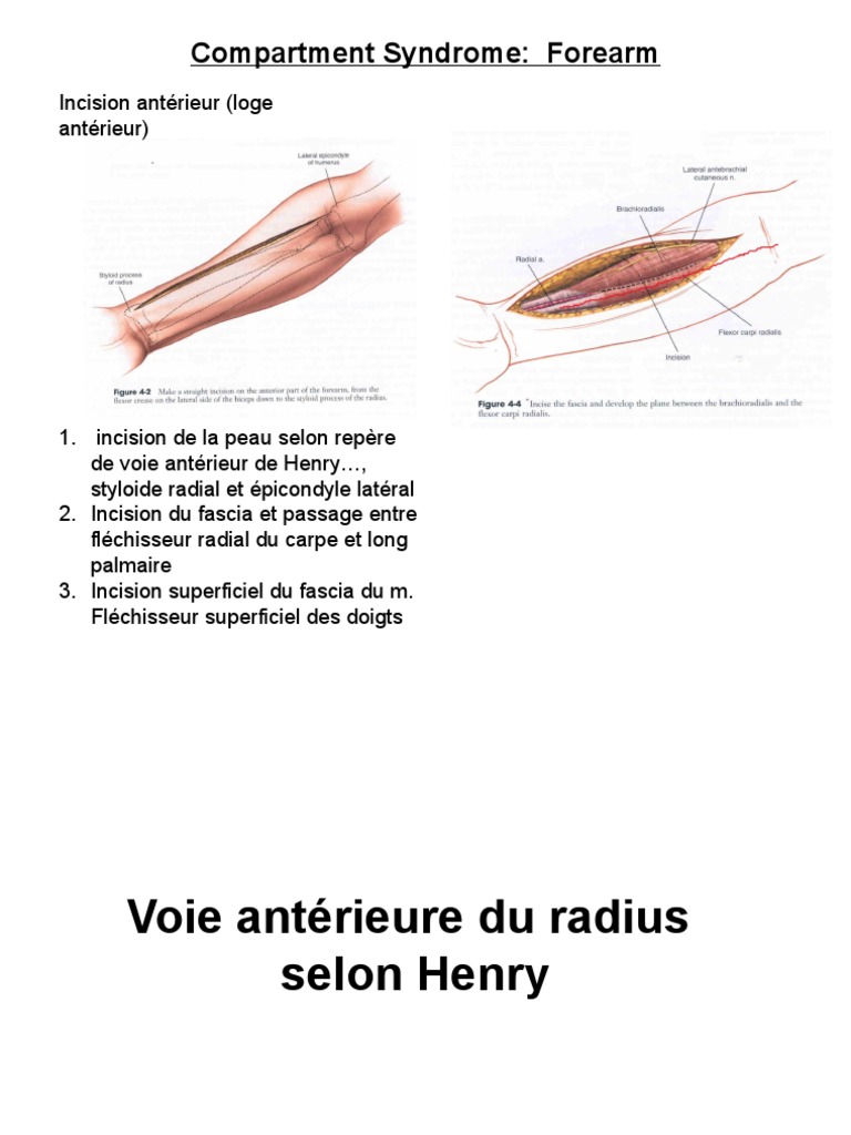 Compartment Syndrome Forearm | PDF