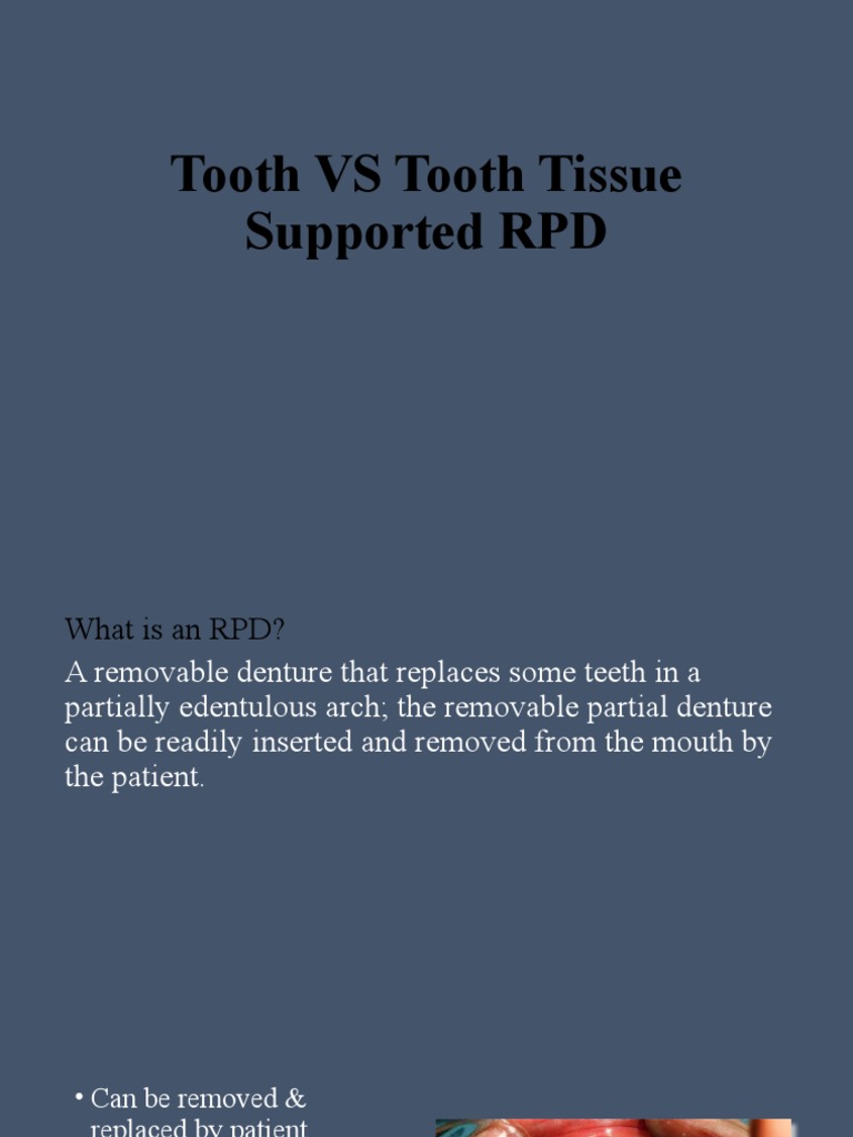 Tooth Vs Tooth Tissue Supported RPD | PDF | Dentures | Dentistry Branches