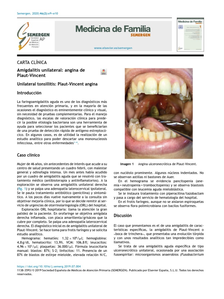 Carta Clínica: Amigdalitis Unilateral: Angina de Plaut-Vincent | PDF ...