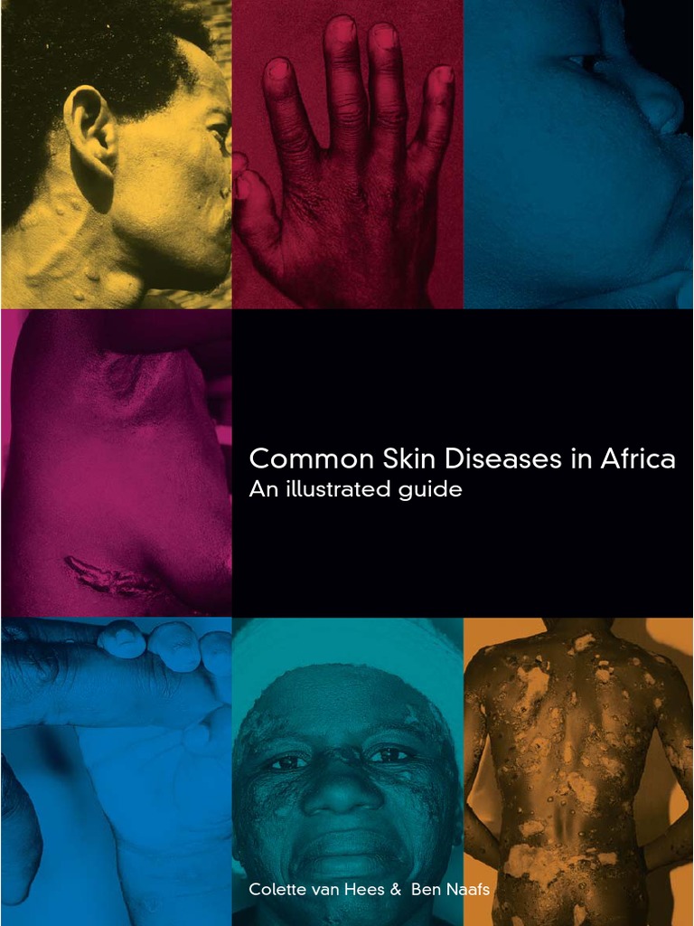 DERM Resource Common+Skin+Diseases+in+Africa-1 | PDF | Dermatitis ...