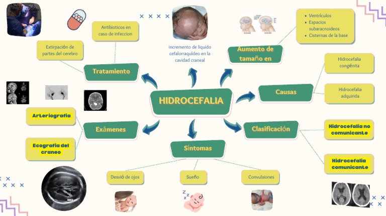 Hidrocefalia | PDF