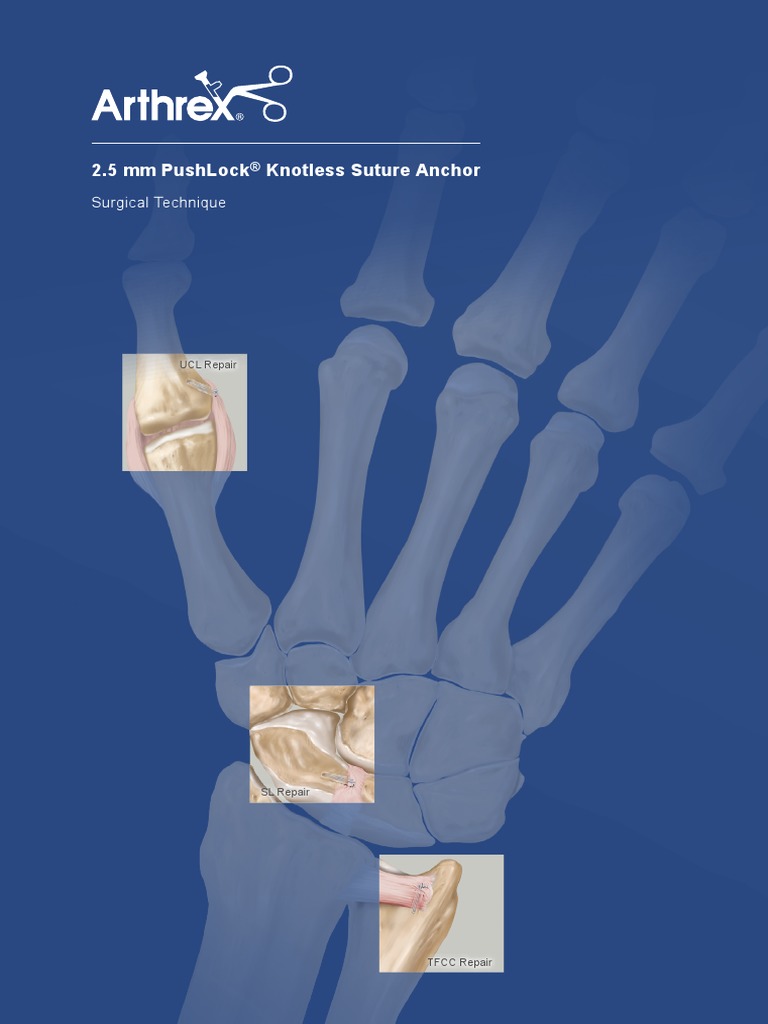 2.5 MM Pushlock Knotless Suture Anchor: Surgical Technique | PDF ...
