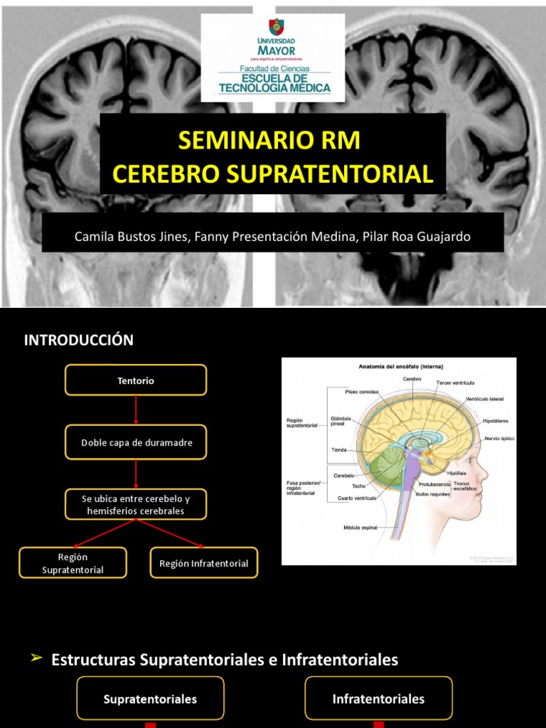 Seminario Neuro Cerebro Supratentorial | PDF | Cerebro | Cerebelo