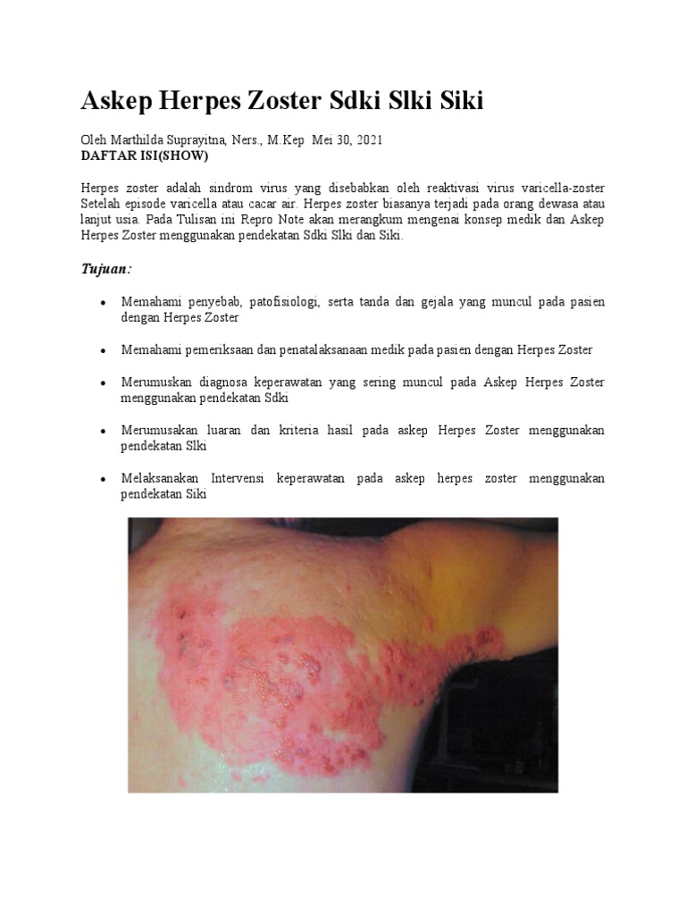 Askep Herpes Zoster 123 | PDF