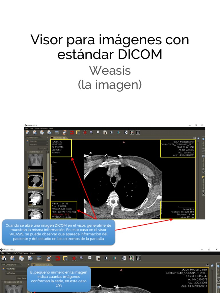 Weasis: Visualizador DICOM para Imágenes | PDF