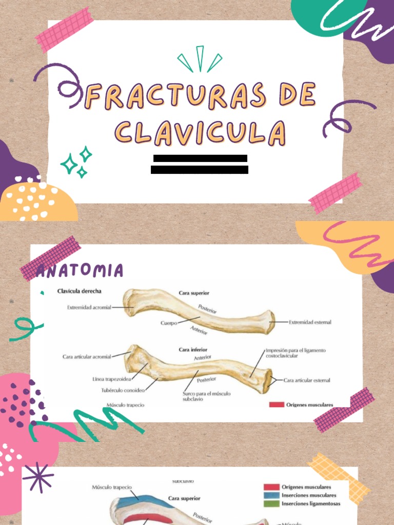 Fractura de Clavicula | PDF | Hombro | Medicina CLINICA