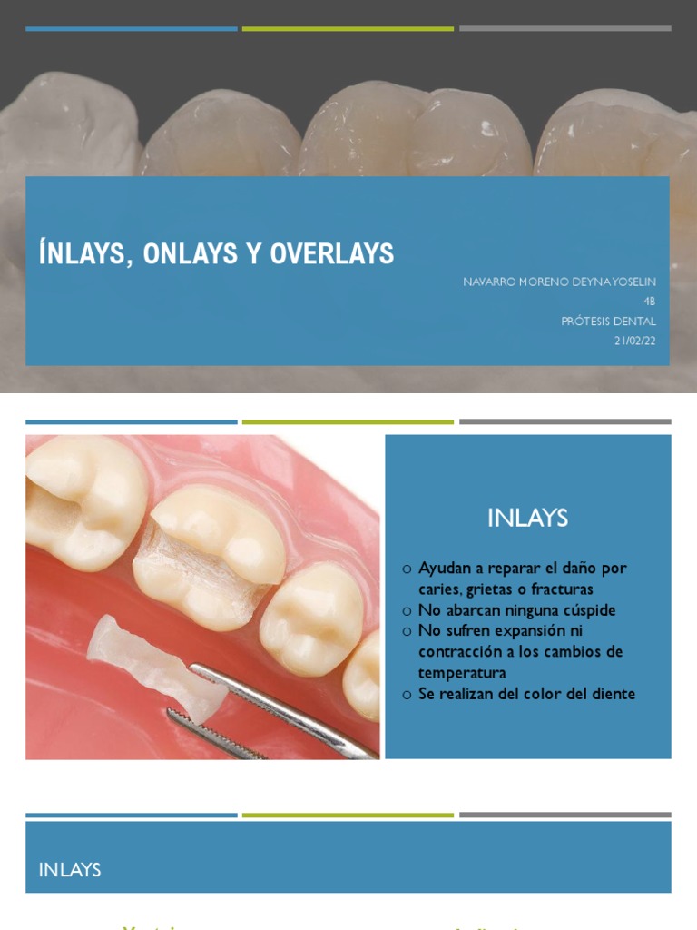Tarea. Ínlays, Onlays y Overlays. | PDF | Dentadura postiza | Materiales