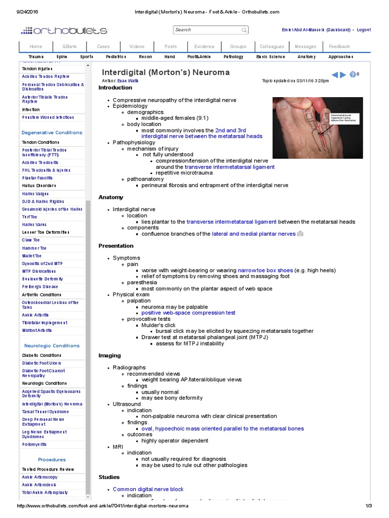 Morton's Neuroma Overview and Treatment | PDF | Toe | Foot