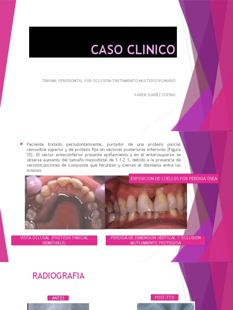 Caso Clinico Trauma Periodontal Por Oclusion | PDF | Dentadura postiza ...