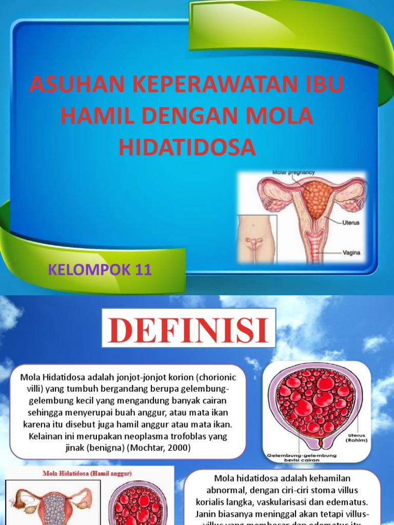 Asuhan Keperawatan Ibu Hamil Dengan Mola Hidatidosa: Kelompok 11 | PDF ...