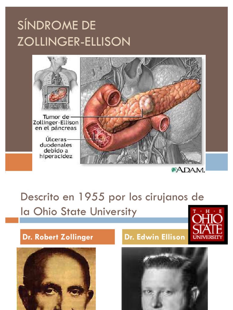 Síndrome de Zollinger-Ellison | PDF
