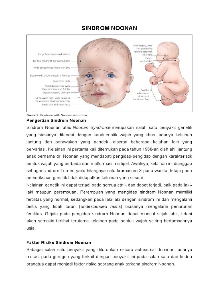 Sindrom Noonan | PDF