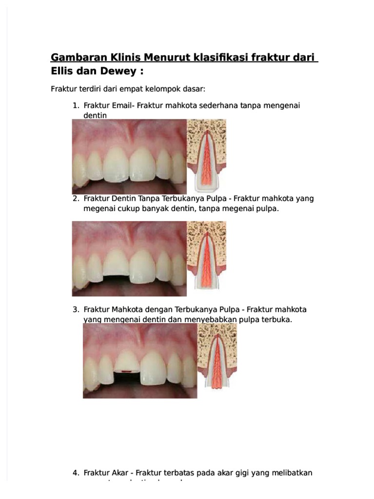 PDF Klasifikasi Fraktur Dari Ellis Dan Dewey - Compress | PDF