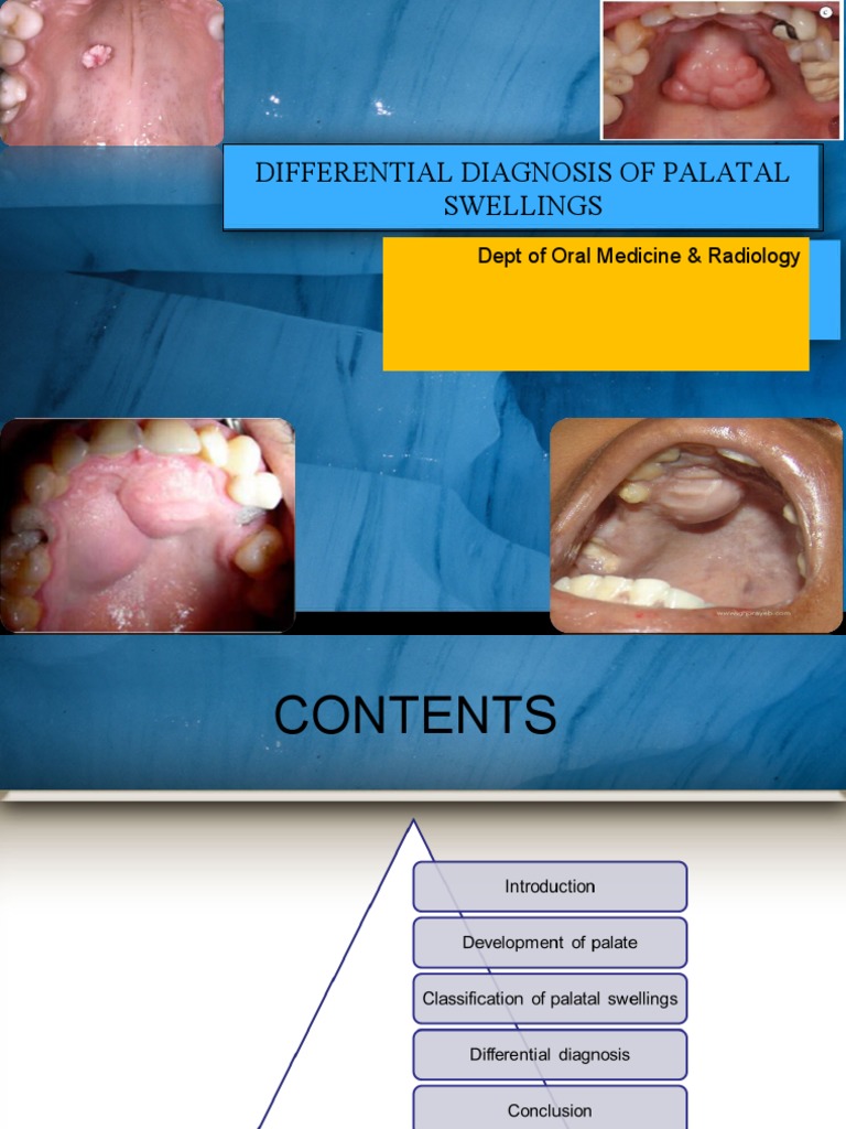 Differential Diagnosis of Palatal Swellings | PDF