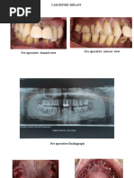 Residual Ridge Resorption Overview | PDF | Bone | Dentures
