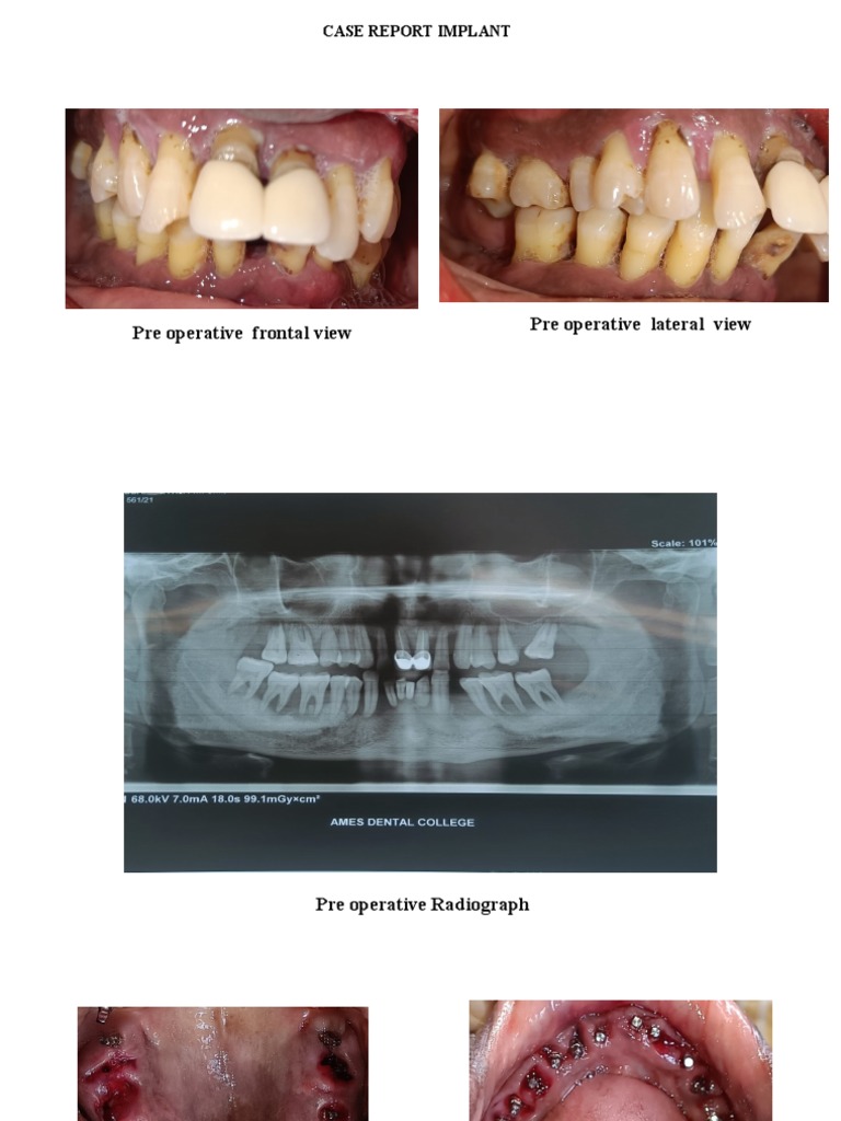 Immediate Loading Dental Implant Case Report | PDF | Science & Mathematics