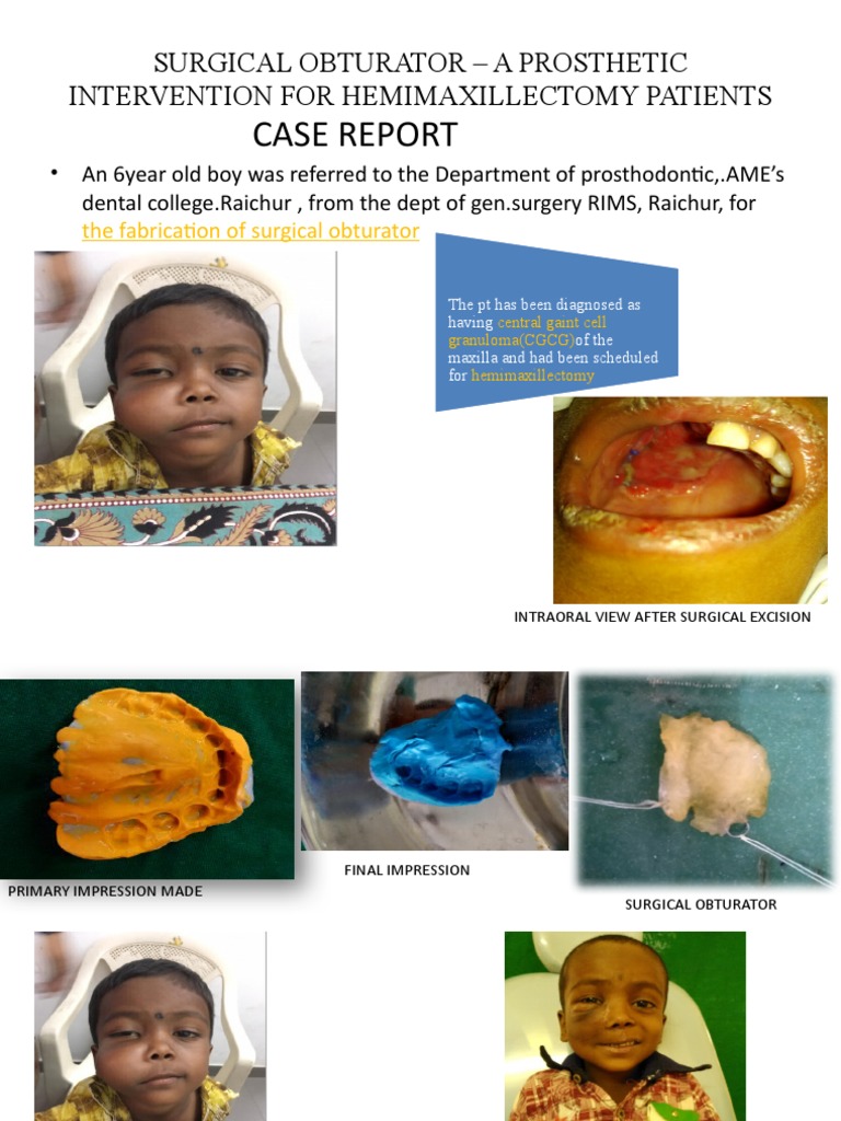Case Report 2 (SURGICAL OBTURATOR - A PROSTHETIC INTERVENTION FOR ...