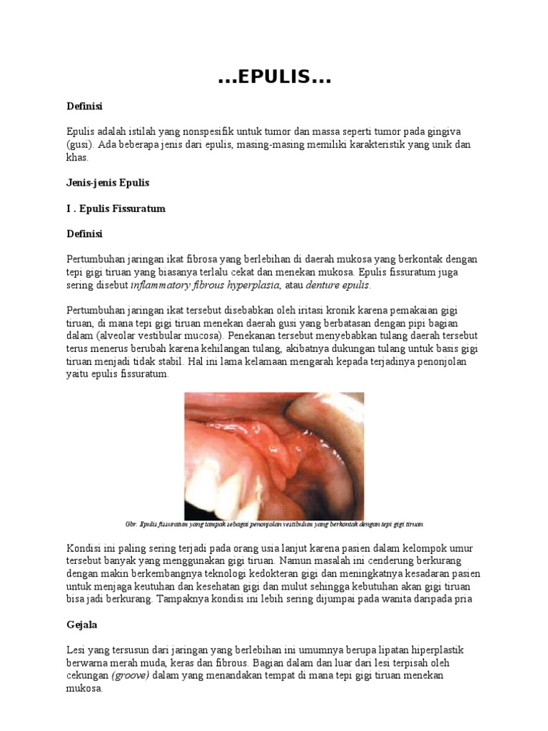Epulis | PDF