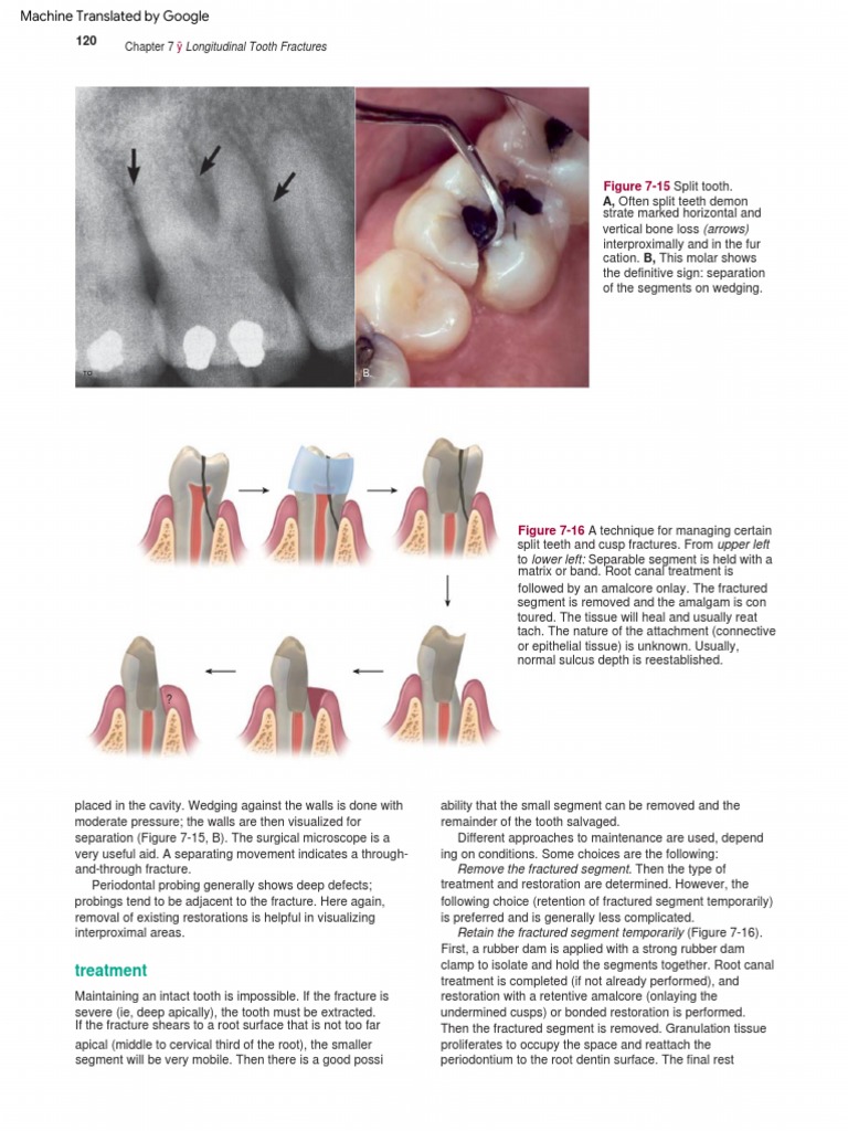 Managing Longitudinal Tooth Fractures | PDF | Tooth | Dental Anatomy