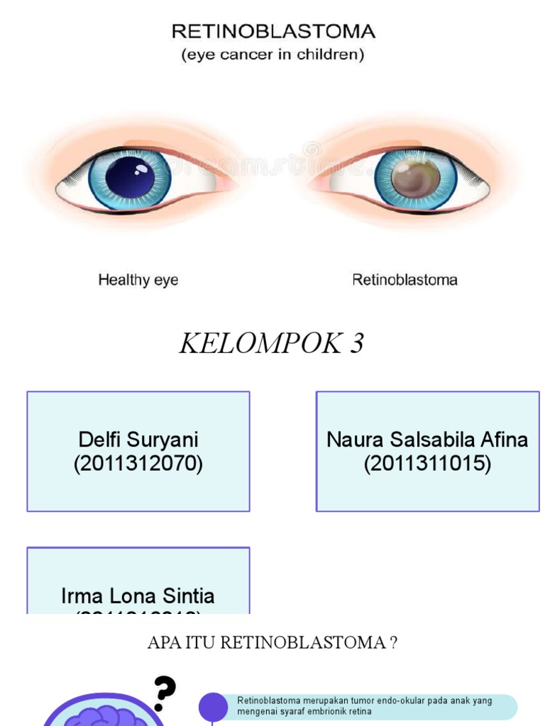 Kel 3 Retinoblastoma | PDF