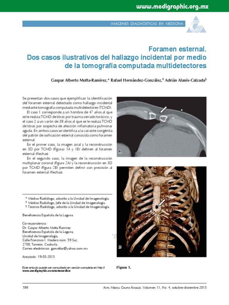 Foramen Esternal. Dos Casos Ilustrativos Del Hallazgo Incidental Por ...