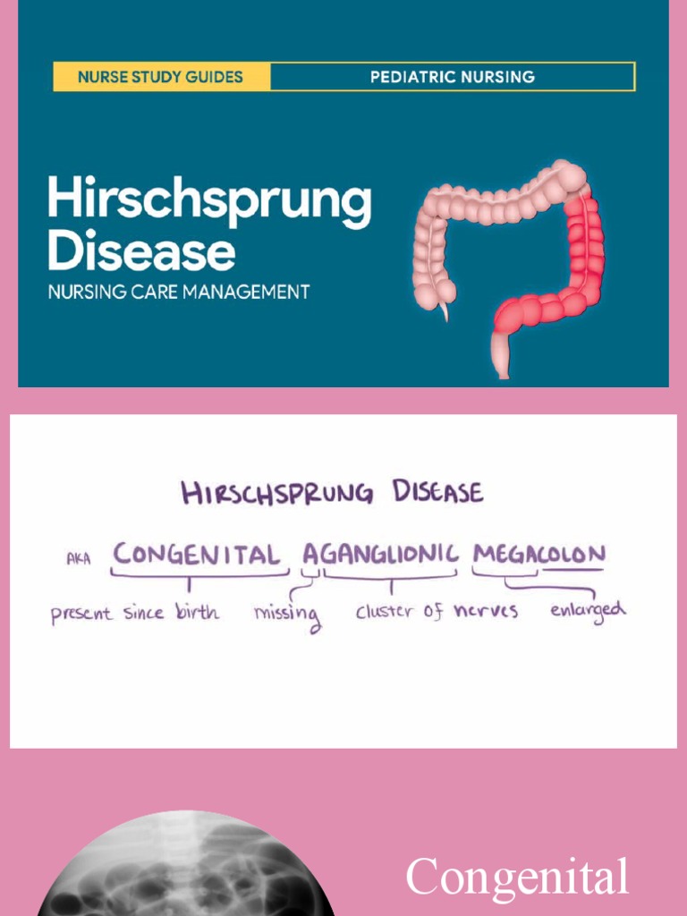 Hirschsprungs Disease | PDF | Rectum | Medicine