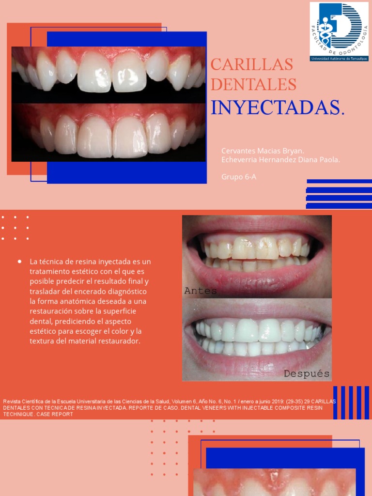 Carillas Inyectadas. | PDF | Odontología | Ciencias de la Salud