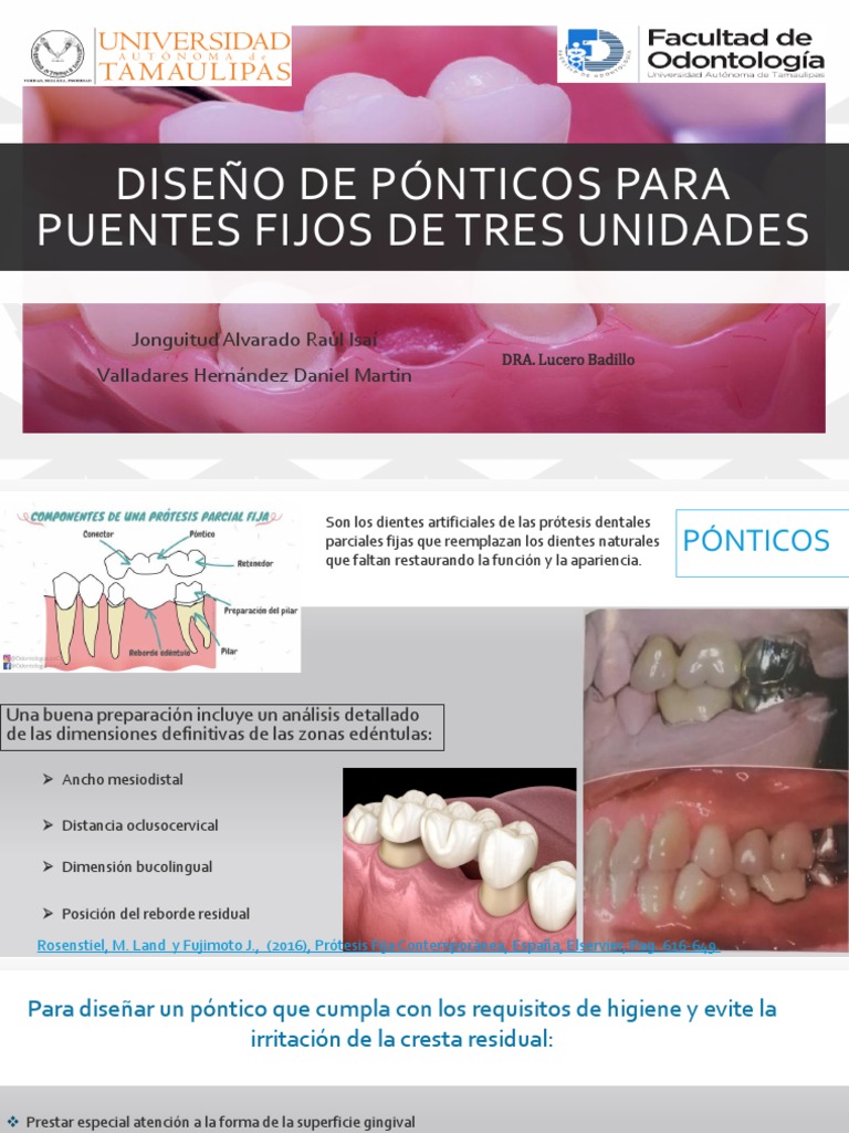Diseño de Ponticos para Puentes Fijos de Tres Unidades | PDF ...
