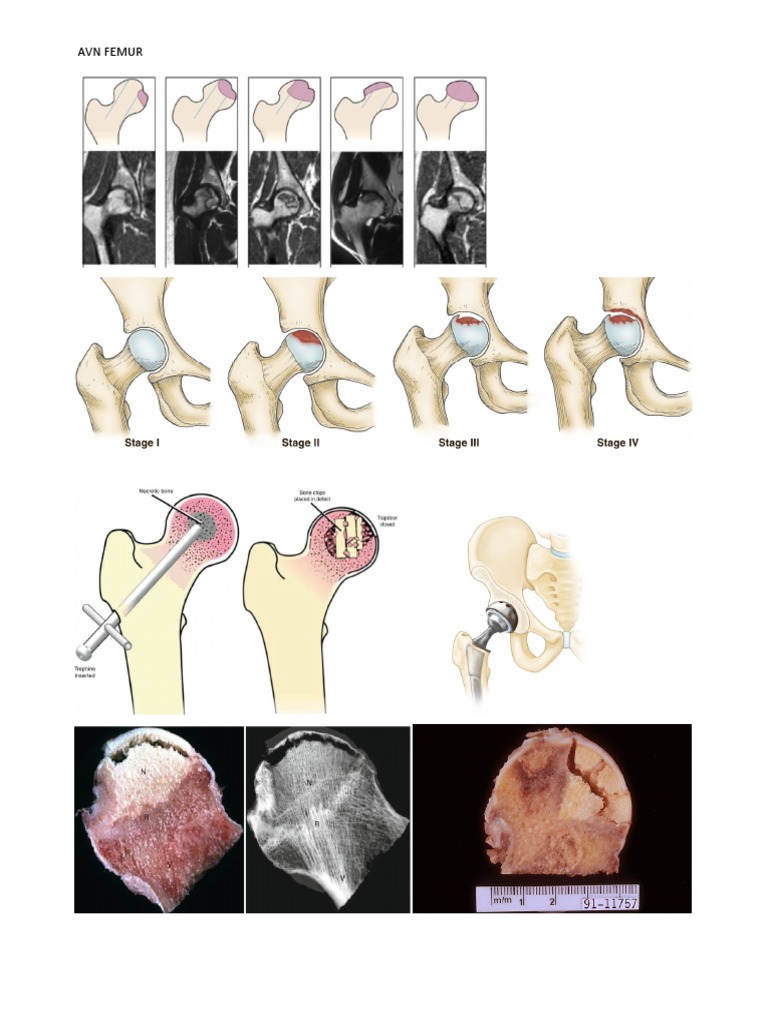 Avn Femur | PDF