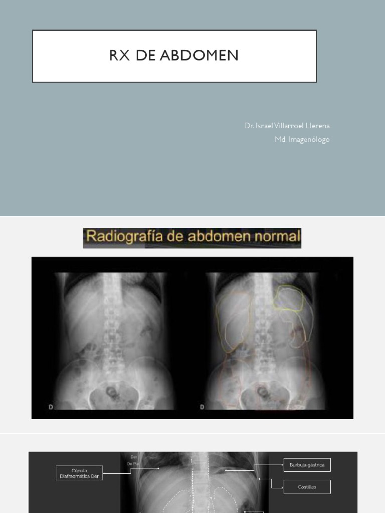 RX de Abdomen - Columna | PDF | La columna vertebral | Enfermedades y trastornos humanos