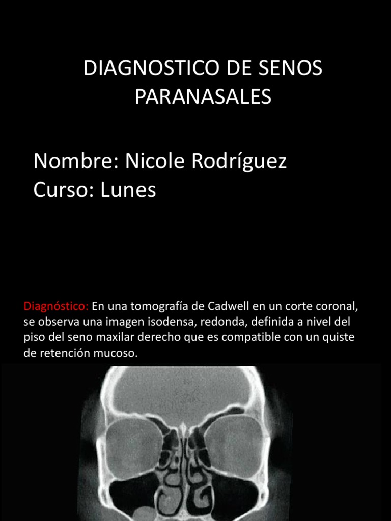 Diagnóstico de Quistes en Senos Paranasales | PDF | Salud y bienestar ...