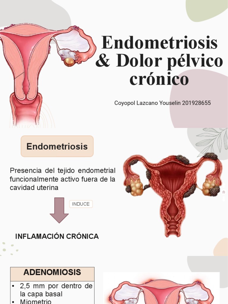 Endometriosis y Dolor Pélvico Crónico | PDF | Menstruación | Ovario