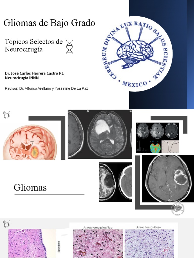 Gliomas de Bajo Grado | PDF | Glioma | Cáncer