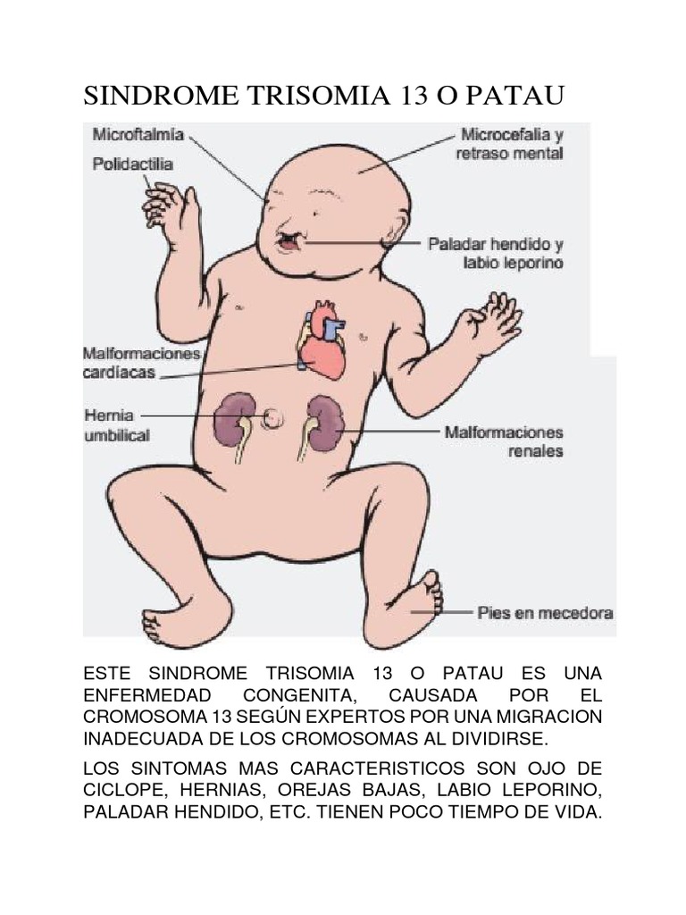 Sindrome Trisomia 13 o Patau | PDF
