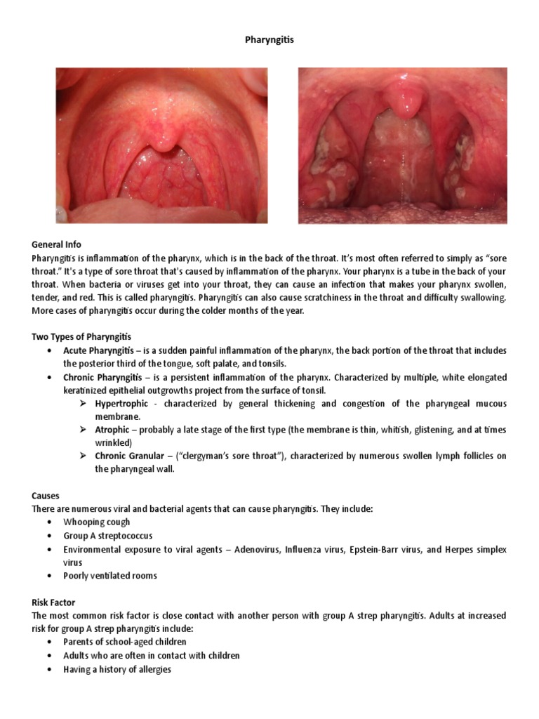 Pharyngitis | PDF | Health Sciences | Respiratory Diseases