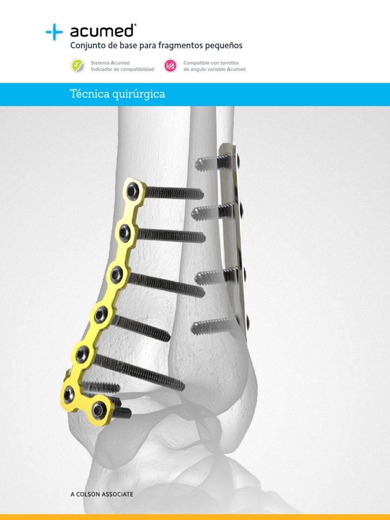 Acumed Surgical Technique ES Small Fragment Base Set ESTMA10 01 A | PDF