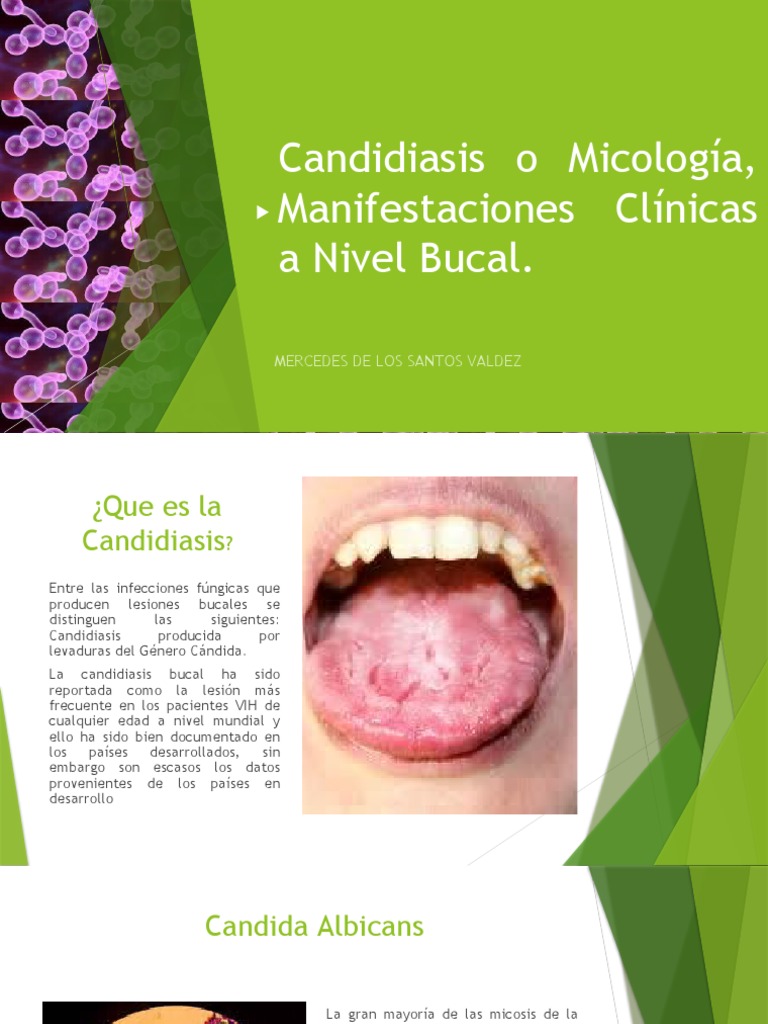 Candidiasis o Micología Manifestaciones Clínicas A Nivel Bucal ...